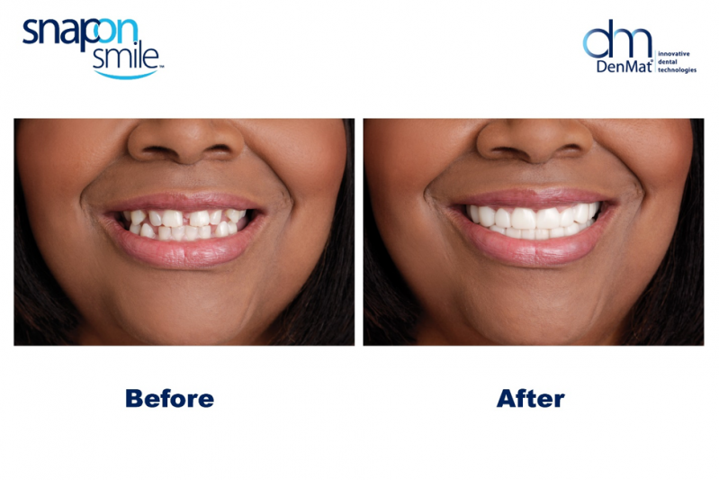 Snap On Smile Missing Teeth